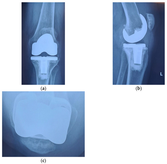 Patellar Resurfacing in Total Knee Arthroplasty, a Never-Ending ...