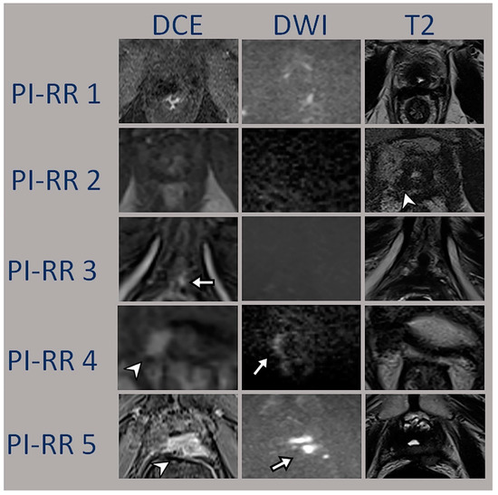 Diagnostics | Free Full-Text | The Role of mpMRI in the Assessment of ...
