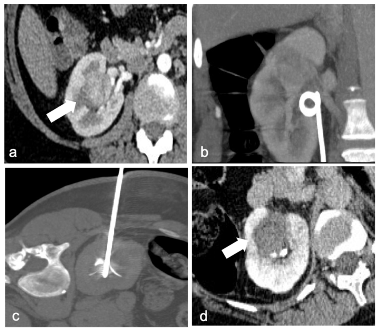 Diagnostics Free Full Text Radiofrequency Ablation Cryoablation