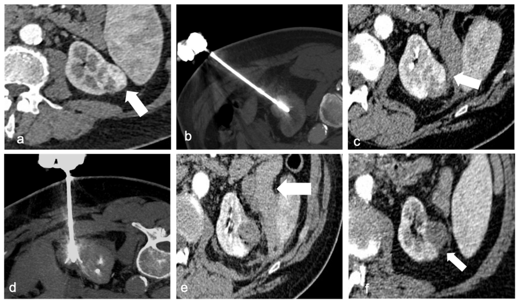 Diagnostics Free Full Text Radiofrequency Ablation Cryoablation