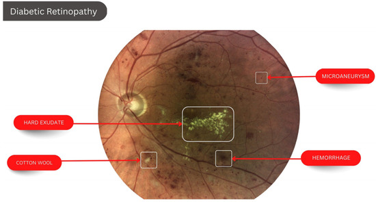 A Prospective Study on Diabetic Retinopathy Detection Based on Modify ...