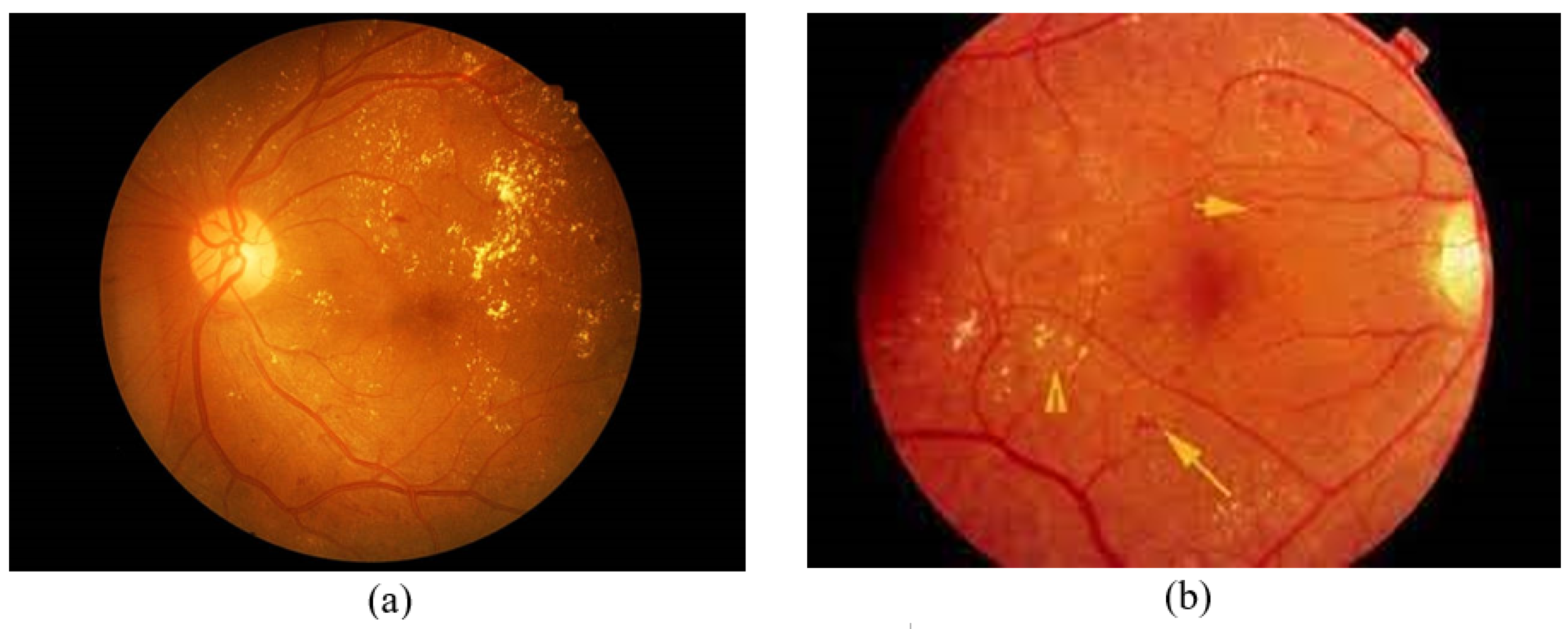 A Prospective Study on Diabetic Retinopathy Detection Based on Modify Convolutional Neural ...