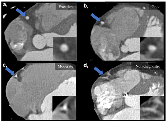 Coronary CTA Amidst the COVID-19 Pandemic: A Quicker Examination ...