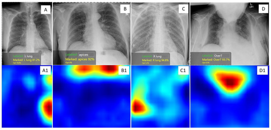 Suboptimal Chest Radiography and Artificial Intelligence: The Problem ...