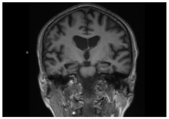 Transcranial Magnetic Stimulation Improves Executive Functioning ...
