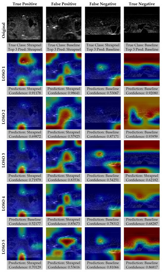 Using Ultrasound Image Augmentation and Ensemble Predictions to Prevent ...