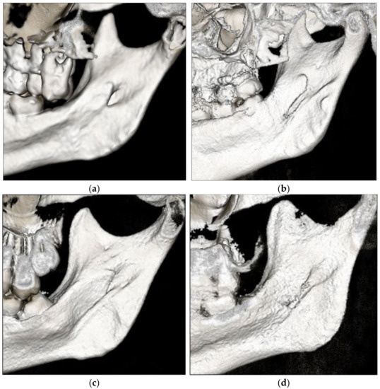 Morphological Analysis of the Mandibular Lingula and Its Relation to ...