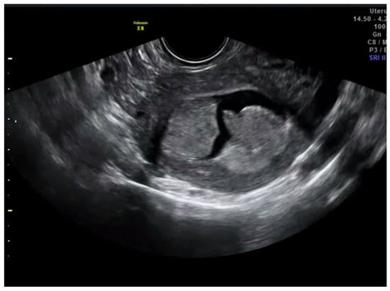 Learning Curve for Ultrasound Assessment of Myometrial Infiltration in ...