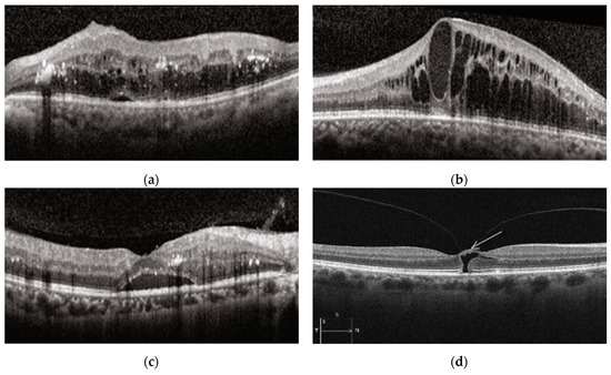 Classification of Retinal Diseases in Optical Coherence Tomography ...