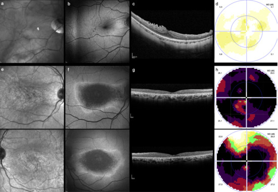 Bull’s Eye Maculopathy in Near-Infrared Reflectance as An Early Sign of ...