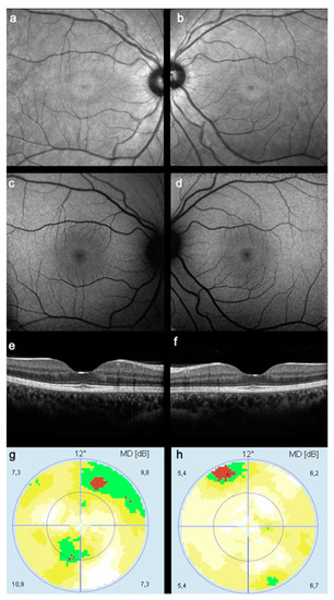 Bull’s Eye Maculopathy in Near-Infrared Reflectance as An Early Sign of ...