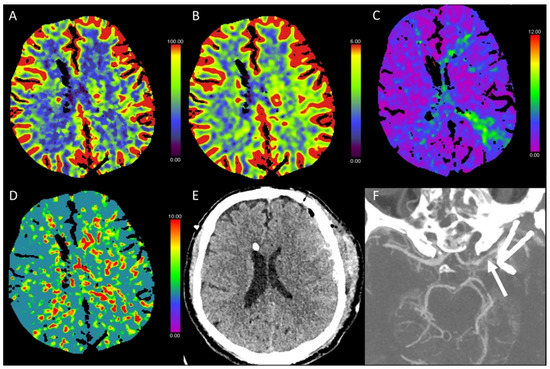 Pictorial Review on Imaging Findings in Cerebral CTP in Patients with ...