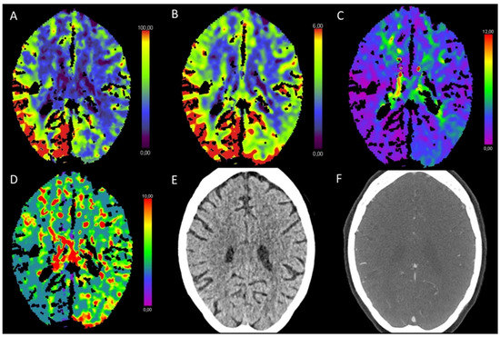 Pictorial Review on Imaging Findings in Cerebral CTP in Patients with ...