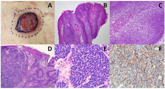 Combined Merkel Cell Carcinoma with Nodal Presentation: Report of a ...