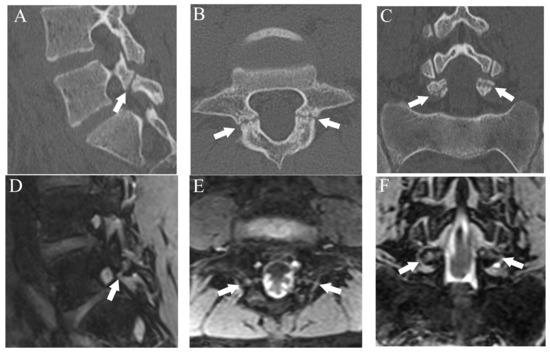 Diagnostic Utility of Double-Echo Steady-State (DESS) MRI for Fracture ...