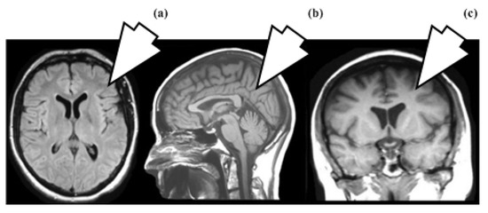 Role of Ensemble Deep Learning for Brain Tumor Classification in ...