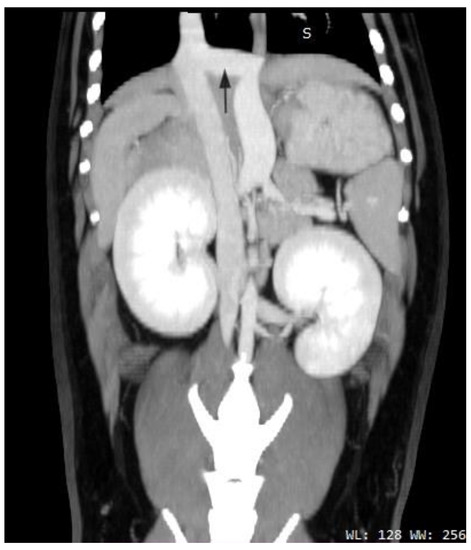 Radiologic Evaluation of Portosystemic Shunts in Humans and Small ...
