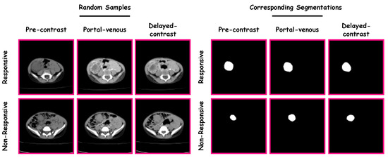 Diagnostics | Free Full-Text | Prediction of Wilms’ Tumor Susceptibility to Preoperative ...