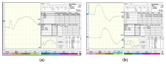 Predicting CTS Diagnosis and Prognosis Based on Machine Learning Techniques