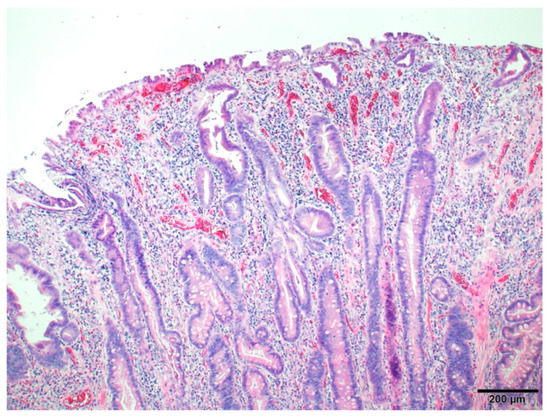 Diagnostics | Free Full-Text | An Isolated Intestinal Juvenile Polyp ...