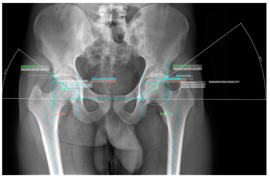 Deep Learning for Fully Automated Radiographic Measurements of the Pelvis and Hip