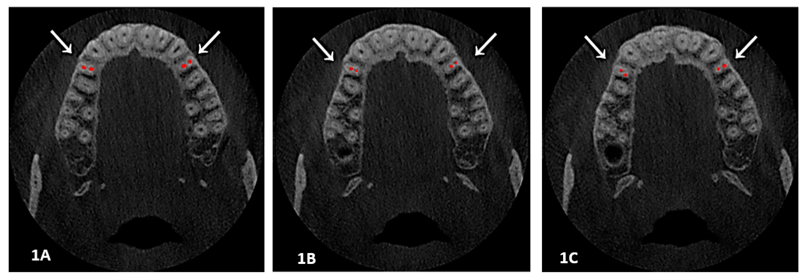 Diagnostics Free Full Text Prevalence Of Second Root And Root Canal