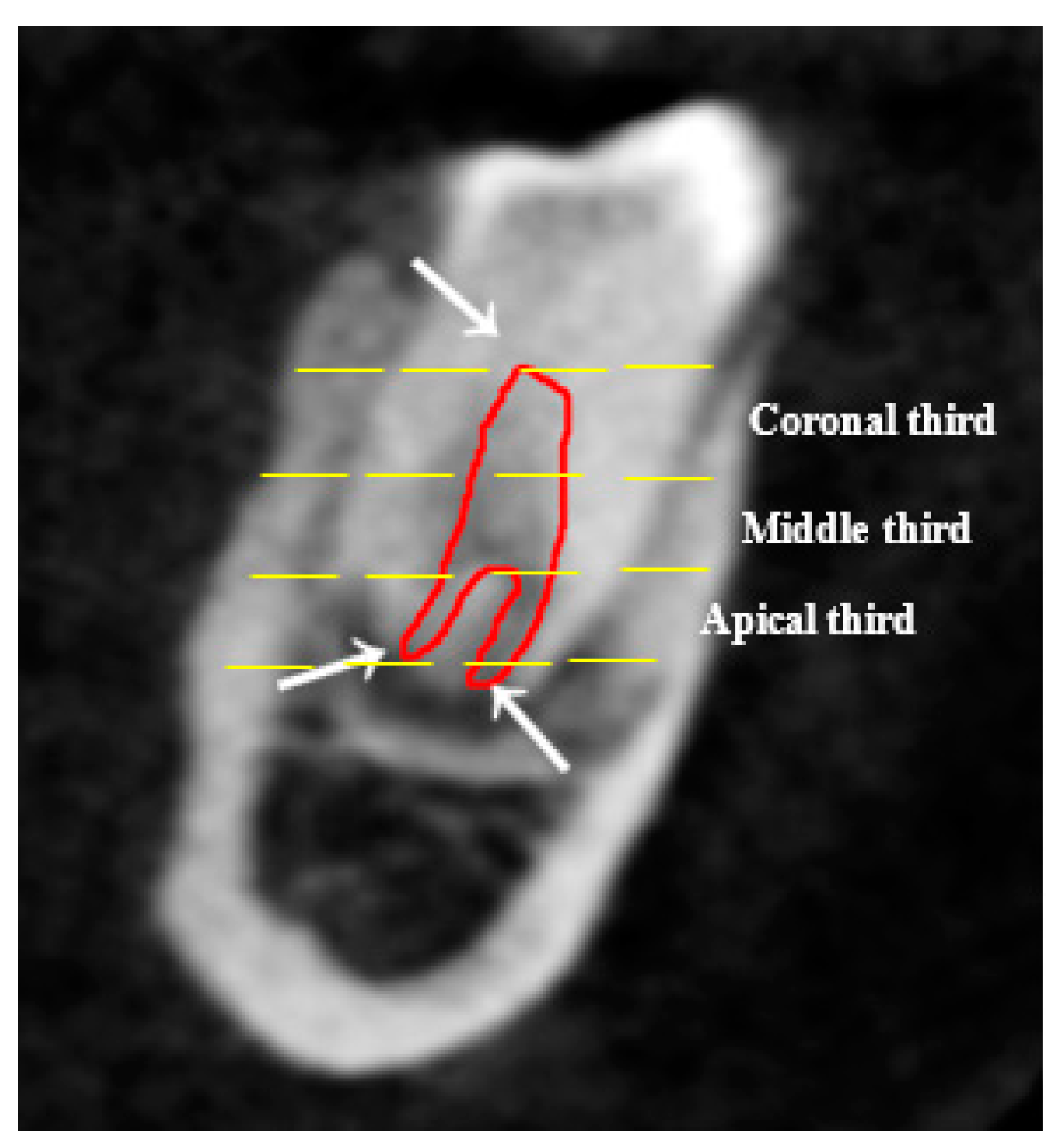 Prevalence of Second Root and Root Canal in Mandibular and Maxillary ...