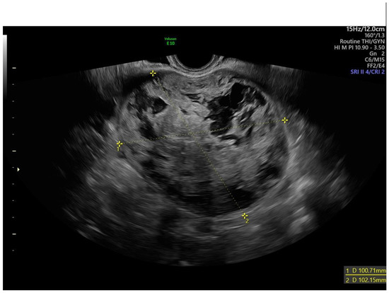 How Frequently Benign Uterine Myomas Appear Suspicious for Sarcoma as ...