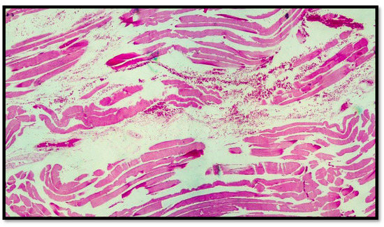 Diagnostic Methods in Forensic Pathology: A New Sign in Death from Hanging