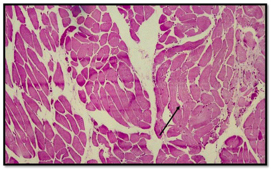 Diagnostic Methods in Forensic Pathology: A New Sign in Death from Hanging