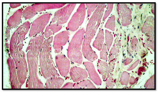 Diagnostic Methods in Forensic Pathology: A New Sign in Death from Hanging