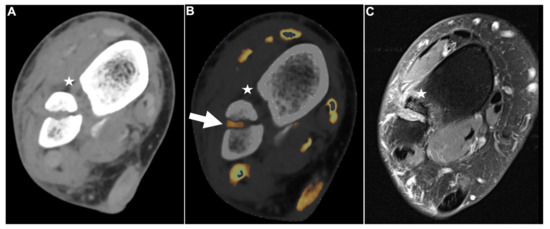 Diagnostic Value of DECT-Based Collagen Mapping for Assessing the ...