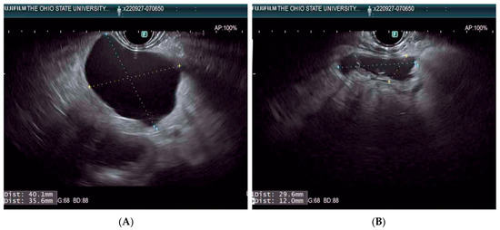 A Review on Endoscopic Ultrasound-Guided Radiofrequency Ablation (EUS ...