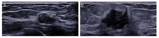 A Novel Nomogram Based on Imaging Biomarkers of Shear Wave Elastography ...