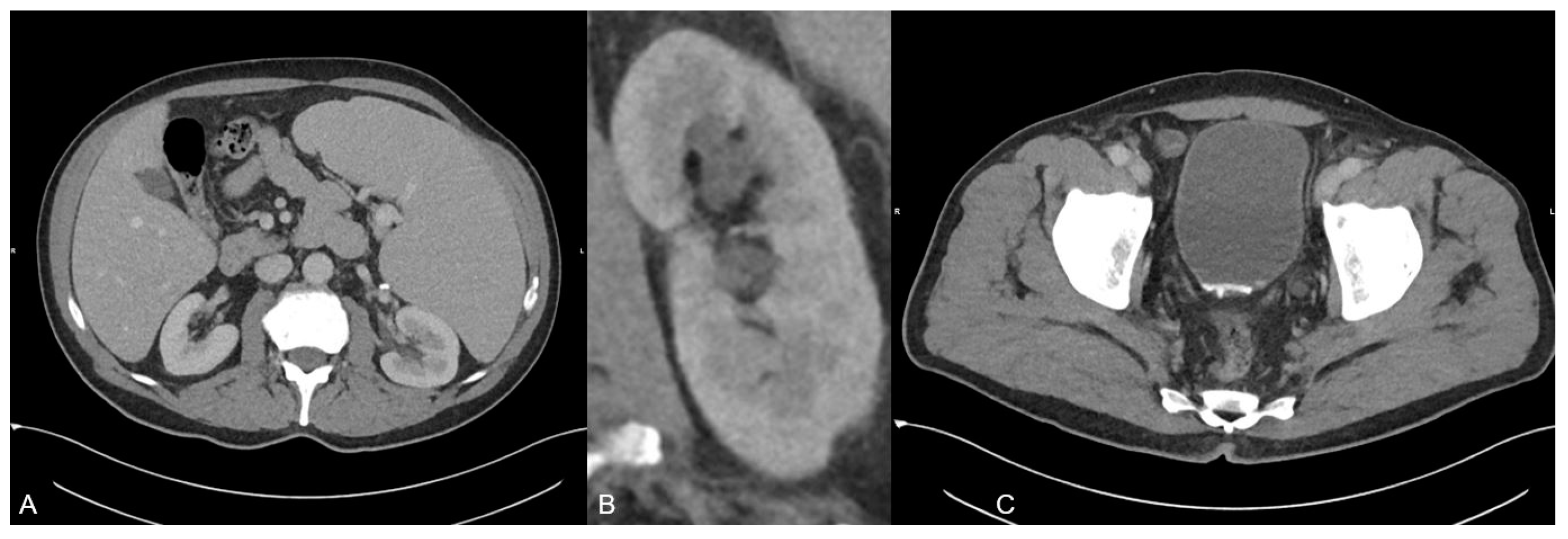 Diagnostics Free Full Text Diagnosis Of Uric Acid Based Urine Sedimentation In The Bladder