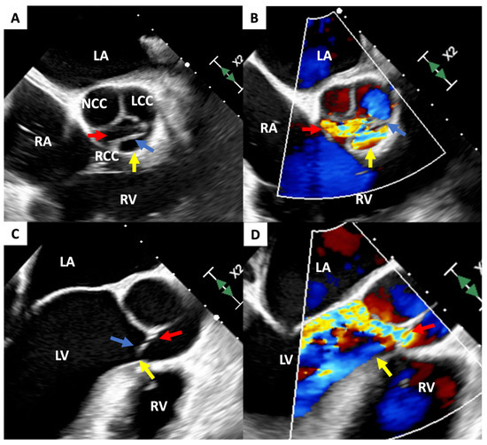 Delayed Aortic Valve Perforation Caused by Blunt Trauma
