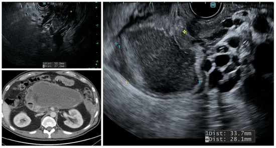 Diagnostics | Free Full-Text | Diagnosis and Management of Pancreatic ...