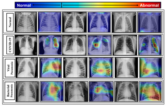DTLCx: An Improved ResNet Architecture to Classify Normal and ...