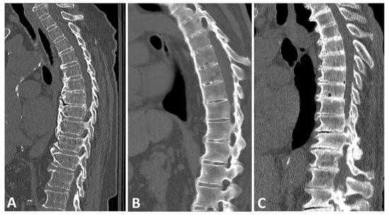 Imaging Characteristics of Diffuse Idiopathic Skeletal Hyperostosis ...