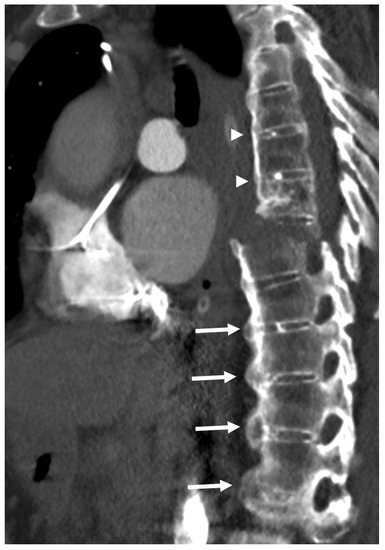 Imaging Characteristics of Diffuse Idiopathic Skeletal Hyperostosis ...