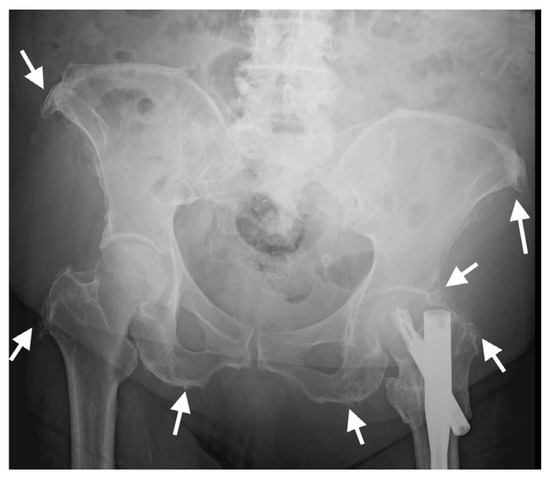 Imaging Characteristics of Diffuse Idiopathic Skeletal Hyperostosis ...