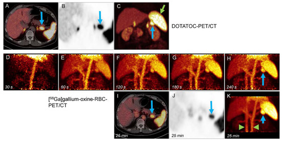 PET/CT of the Spleen with Gallium-Oxine-Labeled, Heat-Damaged Red Blood ...