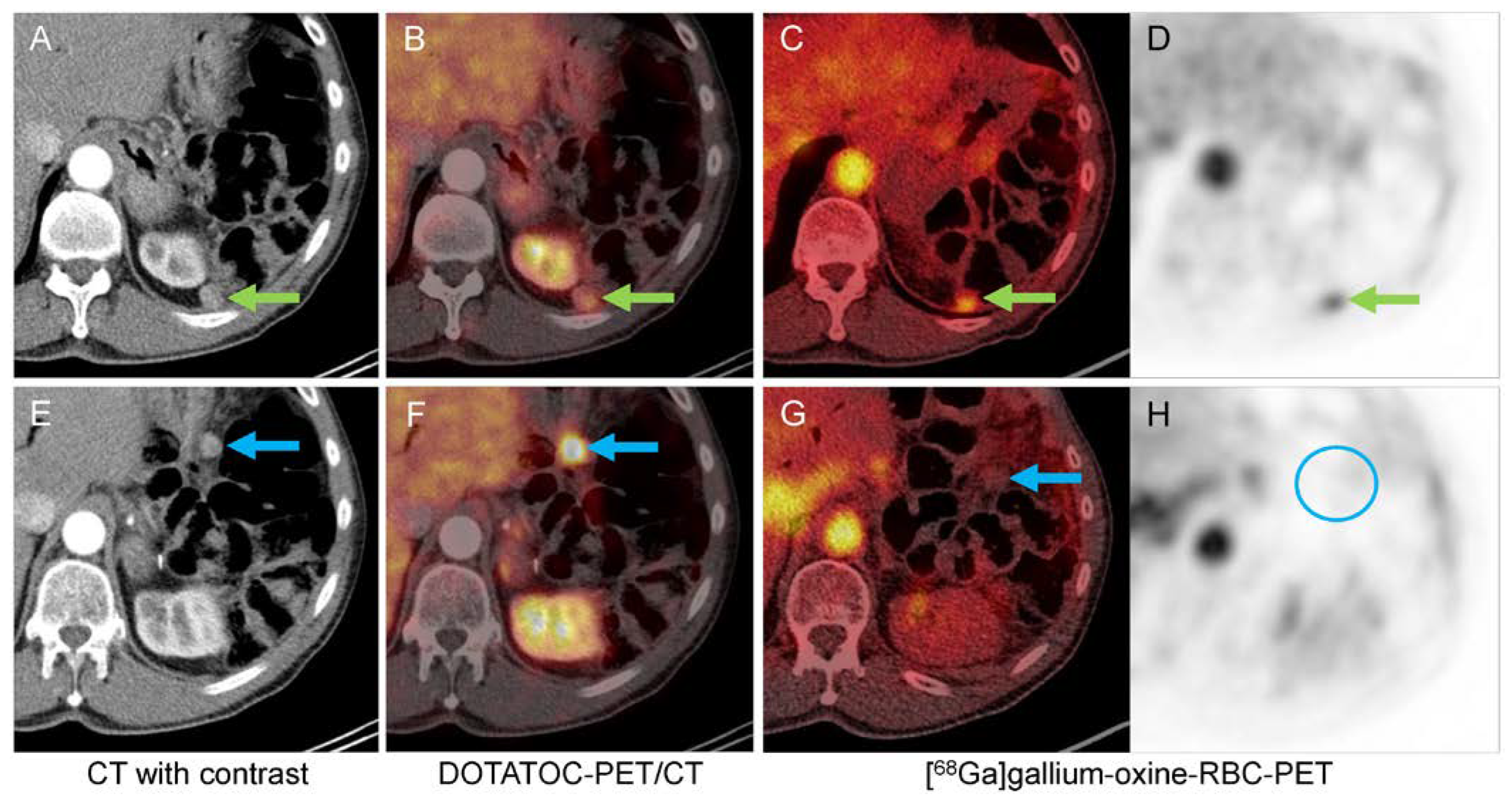 PET/CT of the Spleen with Gallium-Oxine-Labeled, Heat-Damaged Red Blood ...