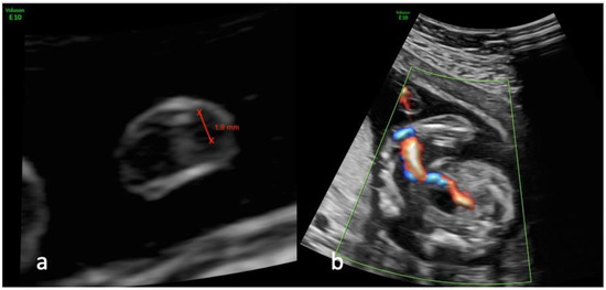 Changes in Artery Diameters and Fetal Growth in Cases of Isolated ...