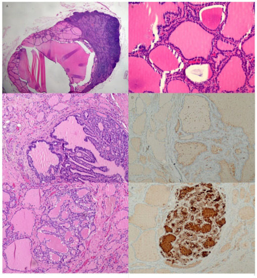 Benign Intranodal Thyroid Tissue Similar to Nodal Metastasis of Thyroid ...