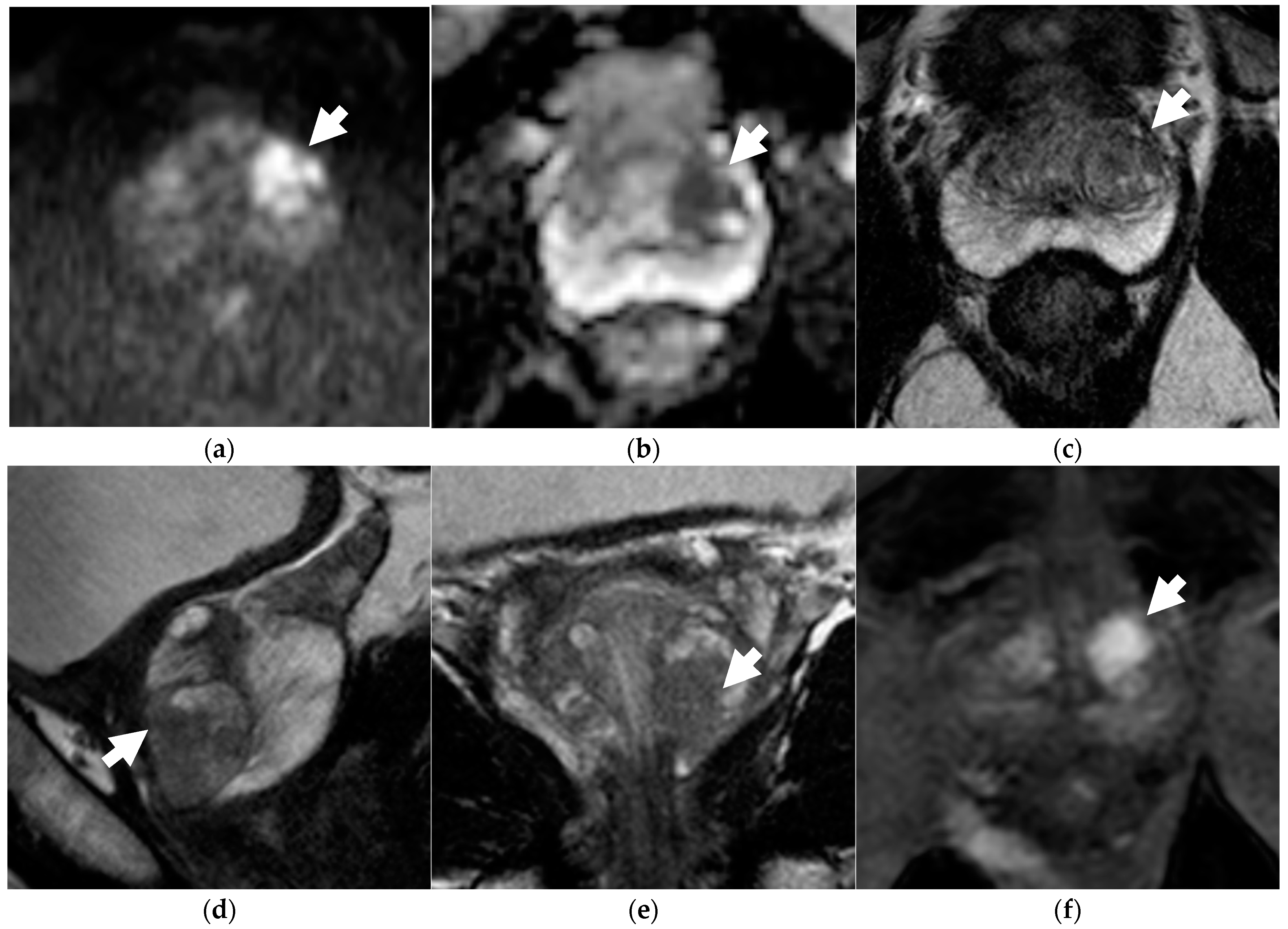Diagnostics | Free Full-Text | Abbreviated Versus Multiparametric Prostate MRI in Active ...