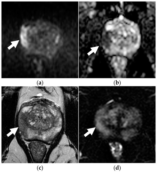 Abbreviated Versus Multiparametric Prostate MRI in Active Surveillance ...