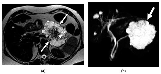 The Role of Magnetic Resonance Imaging (MRI) in the Diagnosis of ...