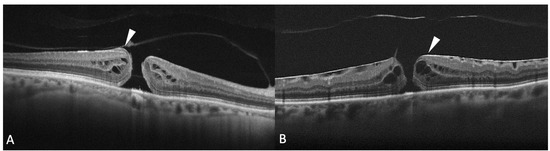 Non-Invasive Retinal Imaging Modalities for the Identification of ...