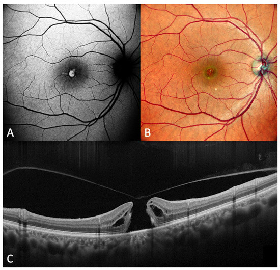 Non-Invasive Retinal Imaging Modalities for the Identification of Prognostic Factors in ...